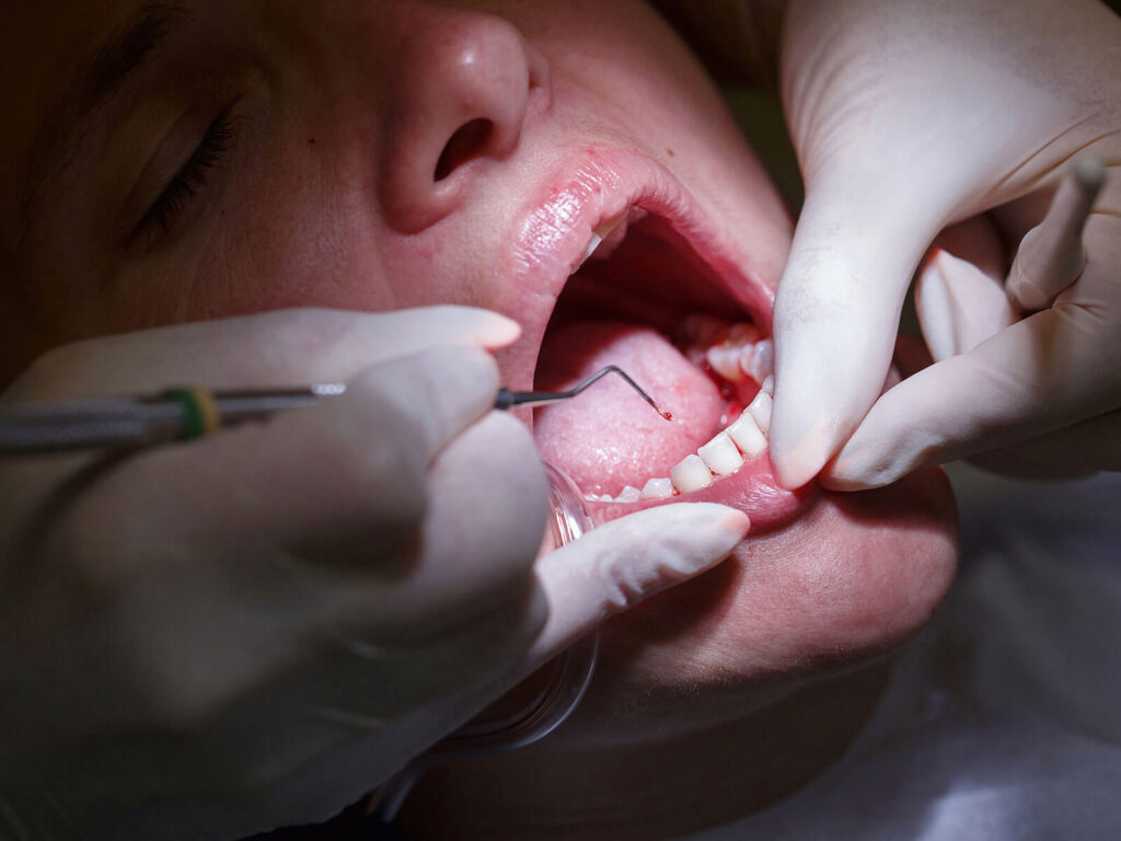 4 Signs You Have Periodontal Gum Disease
